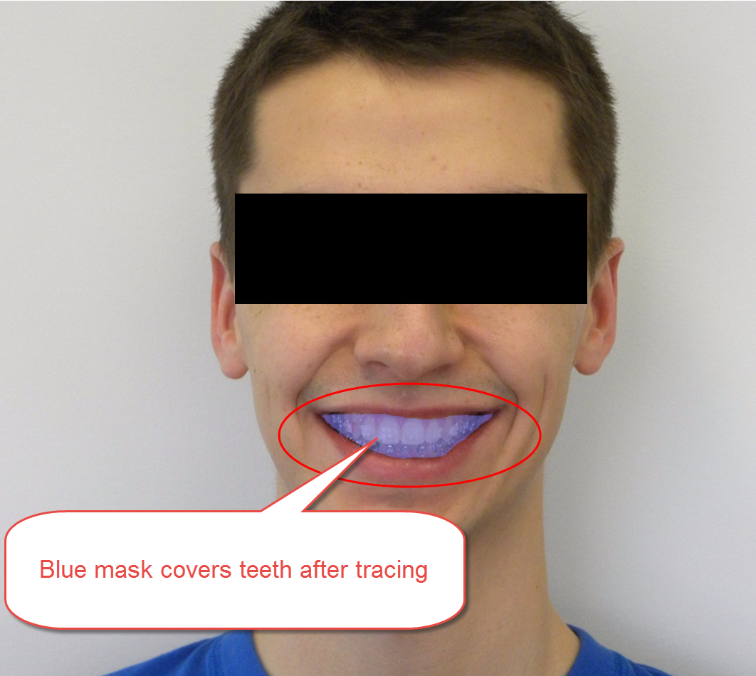 Design the Smile Line with the Lip Trace Line Tool